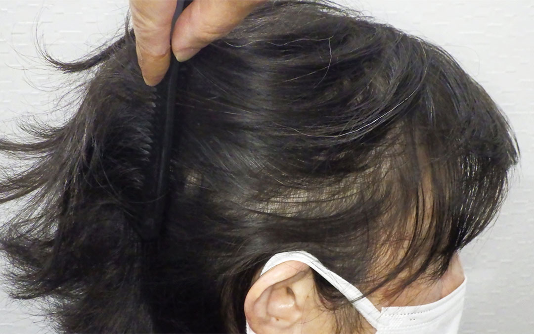 50代女性SDHG療法（自己真皮毛包細胞移植）®モニター様 - SDHG療法毛髪再生研究会