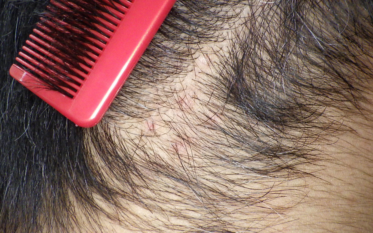 30代男性SDHG療法（自己真皮毛包細胞移植）®モニター様 - SDHG療法毛髪再生研究会