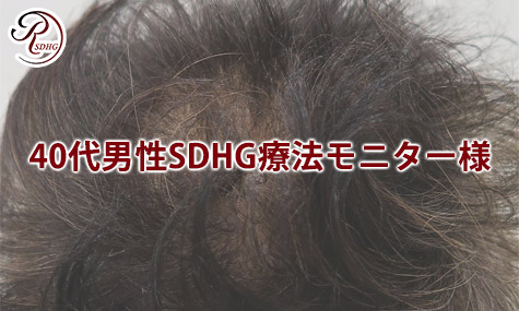 症例 - SDHG療法毛髪再生研究会