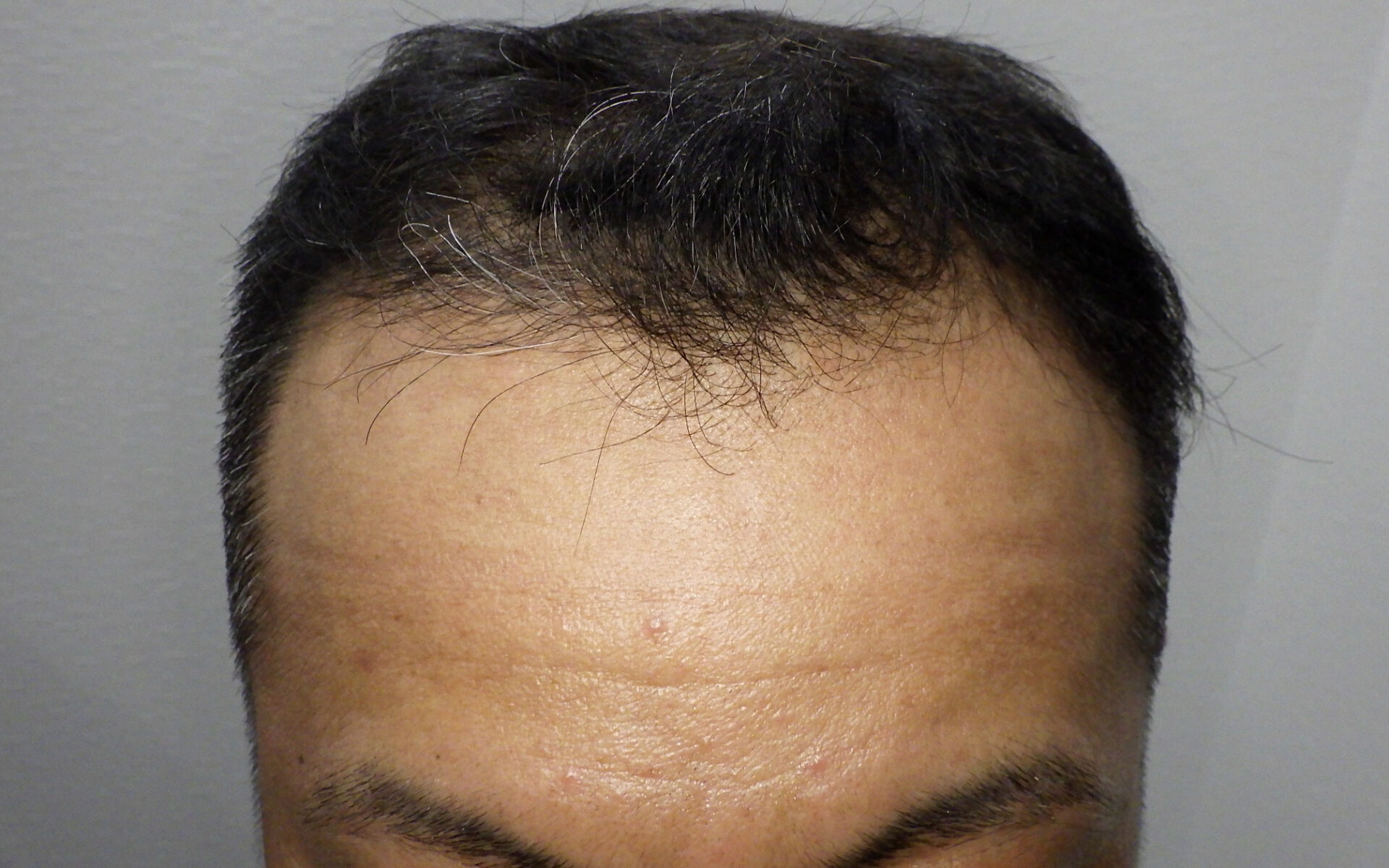 30代男性SDHG療法（自己真皮毛包細胞移植）®モニター様 - SDHG療法毛髪再生研究会