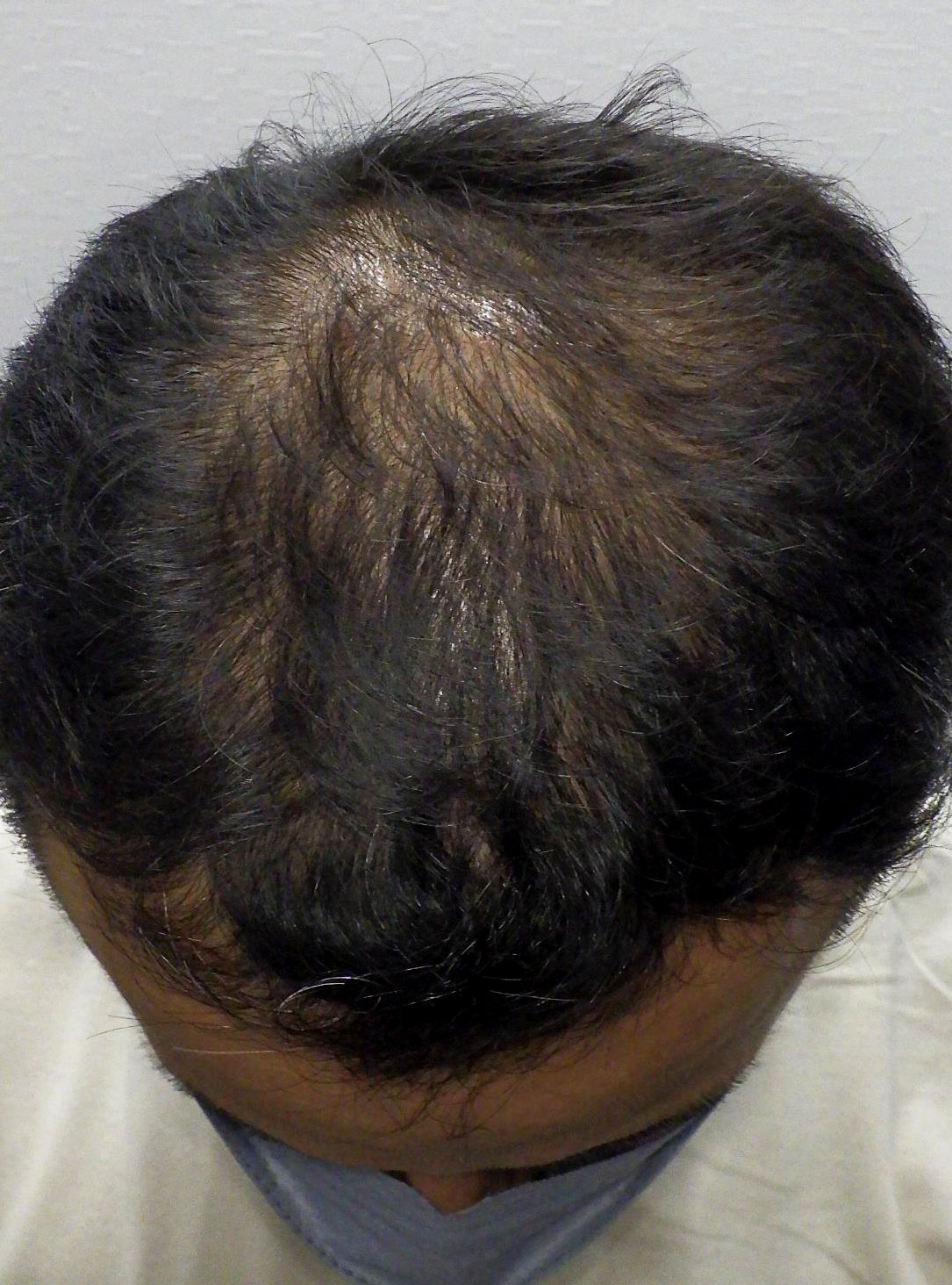 30代男性SDHG療法（自己真皮毛包細胞移植）®モニター様 - SDHG療法毛髪再生研究会