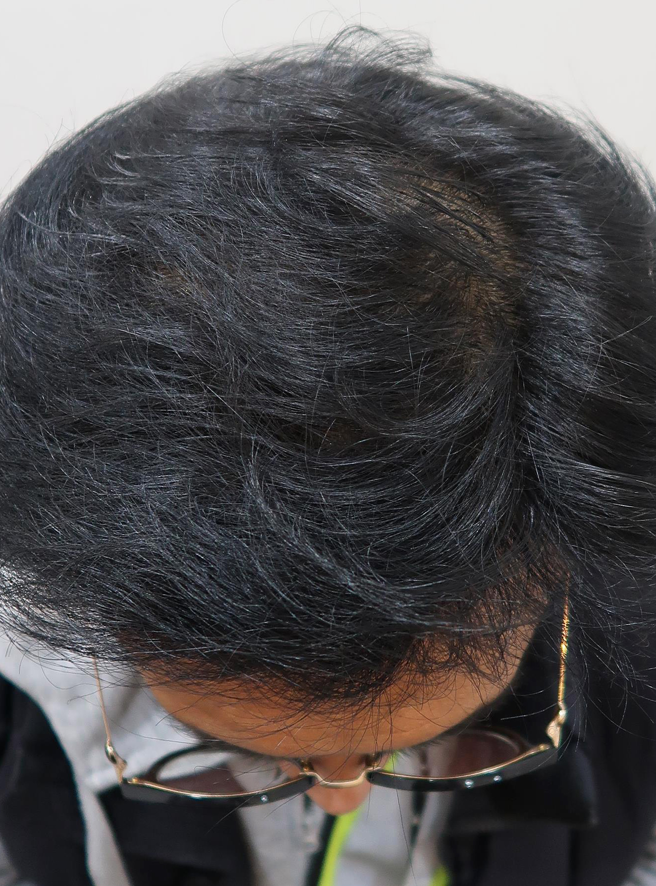 40代男性SDHG療法（自己真皮毛包細胞移植）®モニター様 - SDHG療法毛髪再生研究会